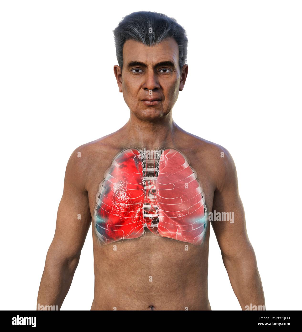 Illustration of a man's thoracic (chest) cavity showing one healthy ...