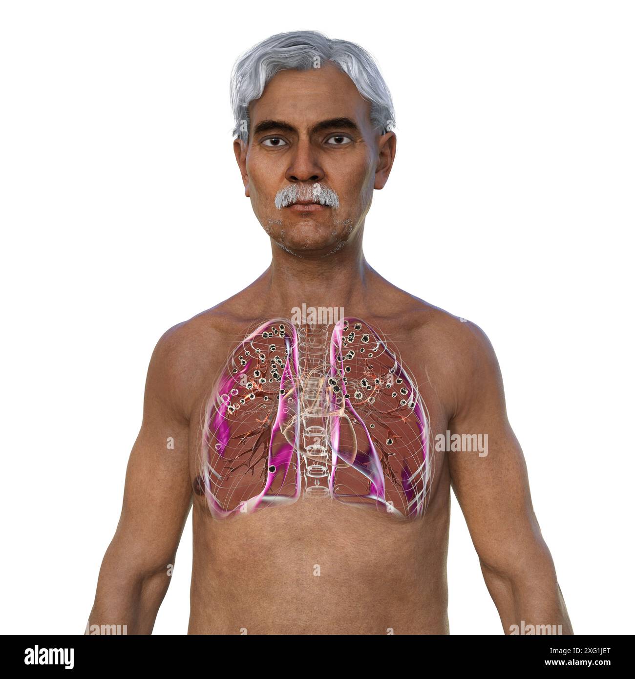 Illustration of a man with lungs affected by silicosis, showing dark ...