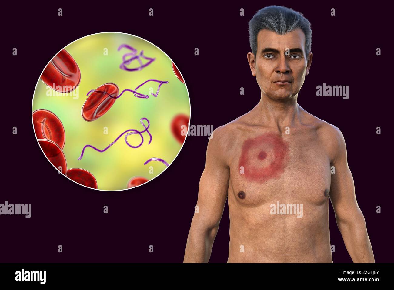 Illustration showing erythema migrans, a characteristic rash seen in ...