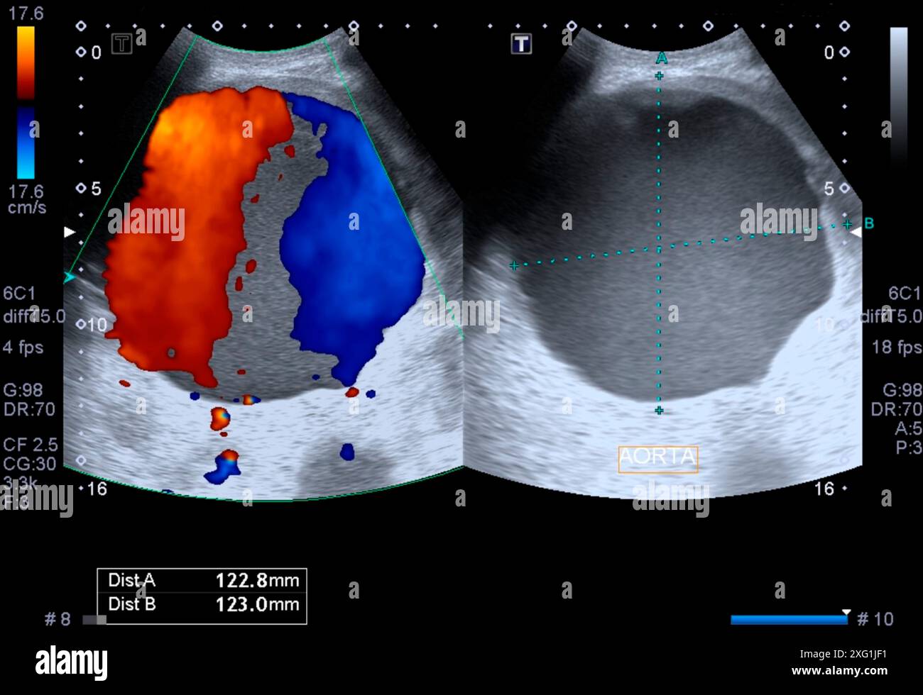 Aortic Aneurysm Ultrasound