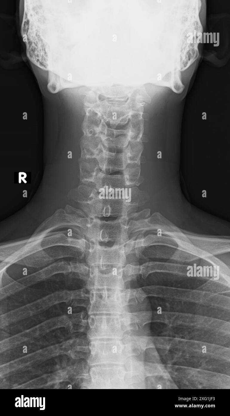 X-ray of the cervical (neck) region of a healthy person's spine Stock ...