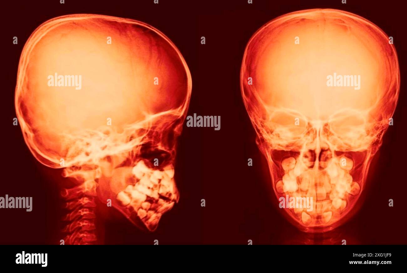 Coloured X-rays of a healthy skull, from an anterior (front) and ...