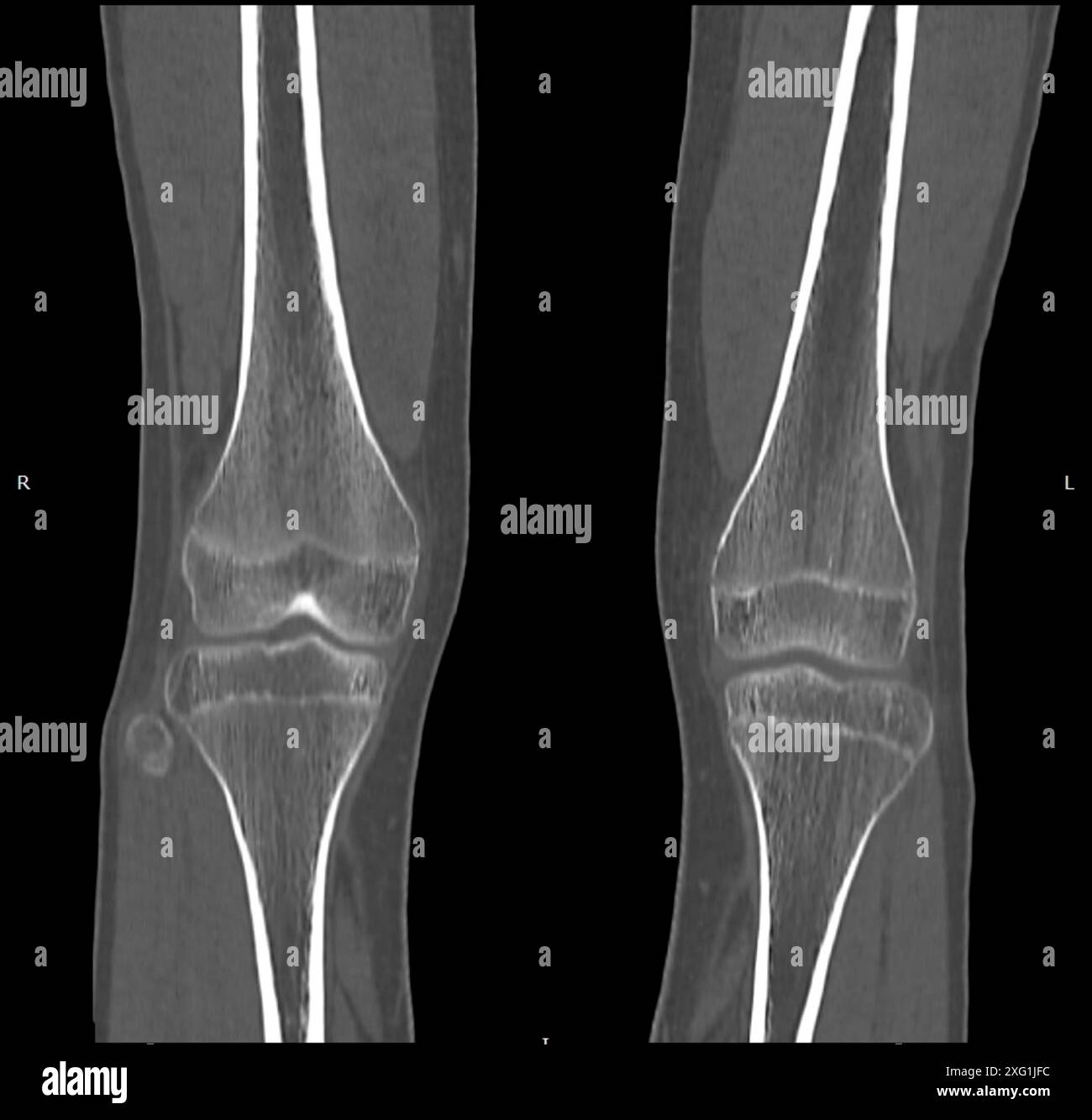 Coloured computed tomography (CT) scan of healthy knees Stock Photo - Alamy Coloured computed tomography (CT) scan of healthy knees Stock Photo - Alamy