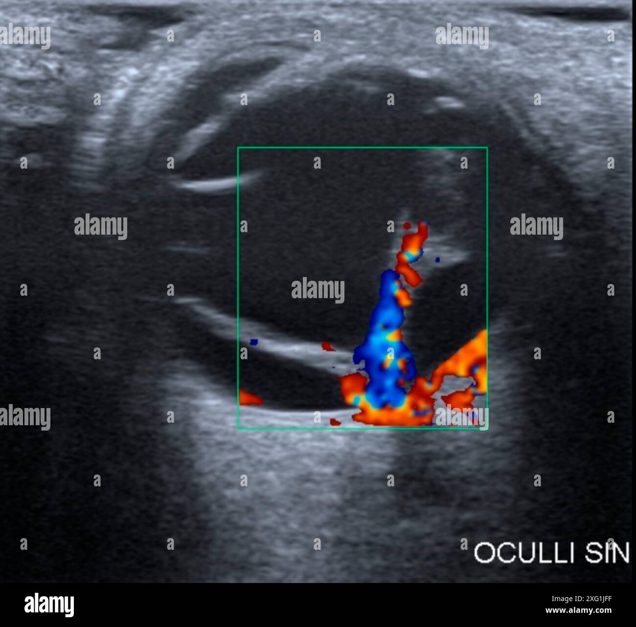 Ultrasound scan of a patient with a detached retina (within green ...