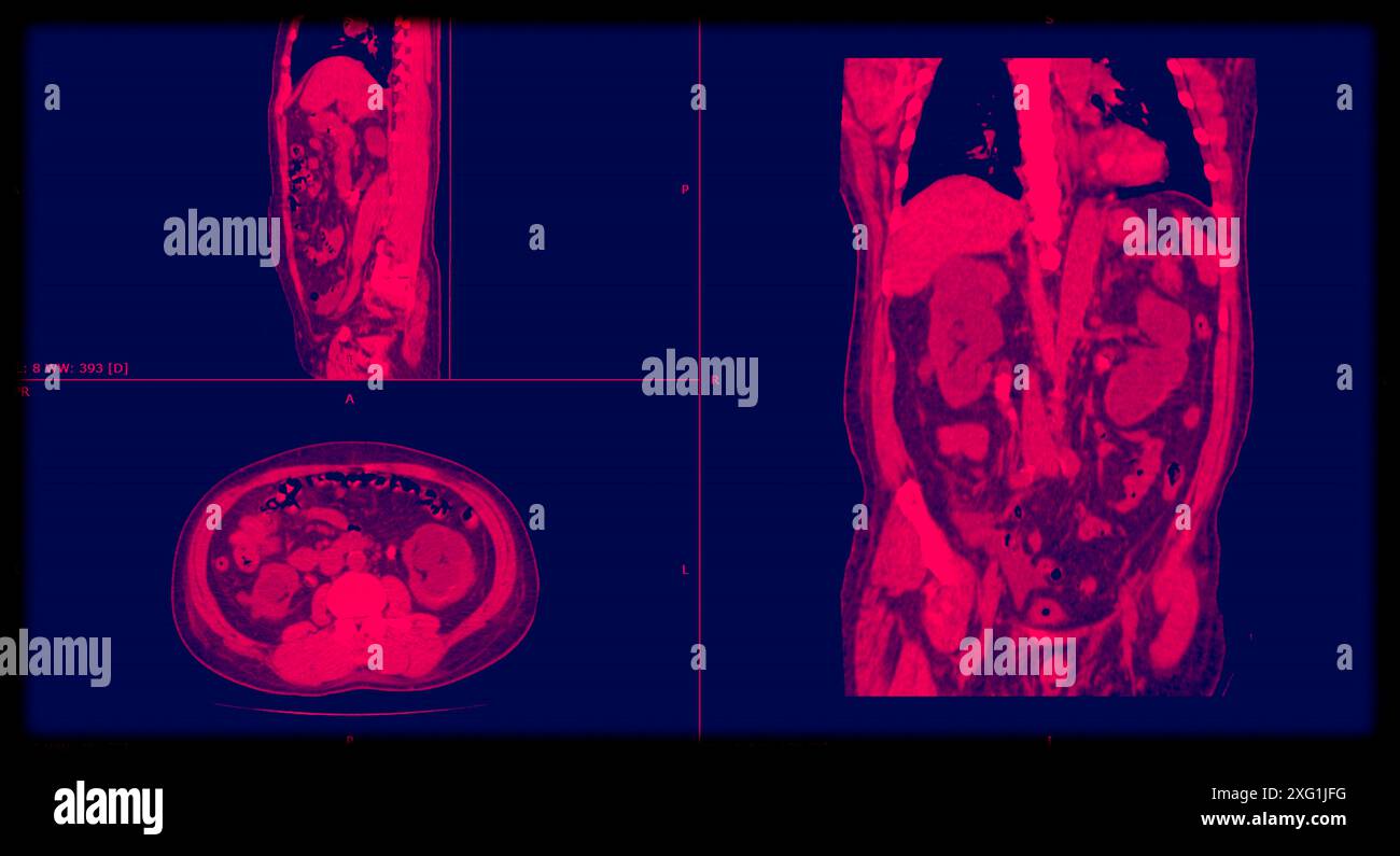 Computed tomography (CT) scan of a patient with ureterolithiasis ...