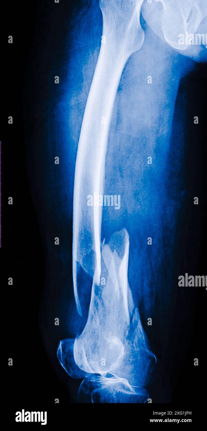 Coloured X-ray of a comminuted femur (thigh bone) fracture. This is a ...