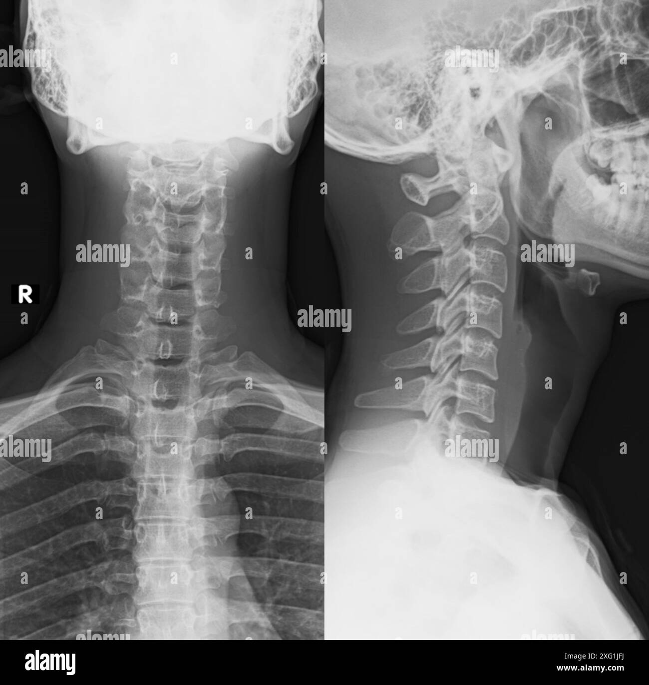 Normal neck x ray hi-res stock photography and images - Alamy