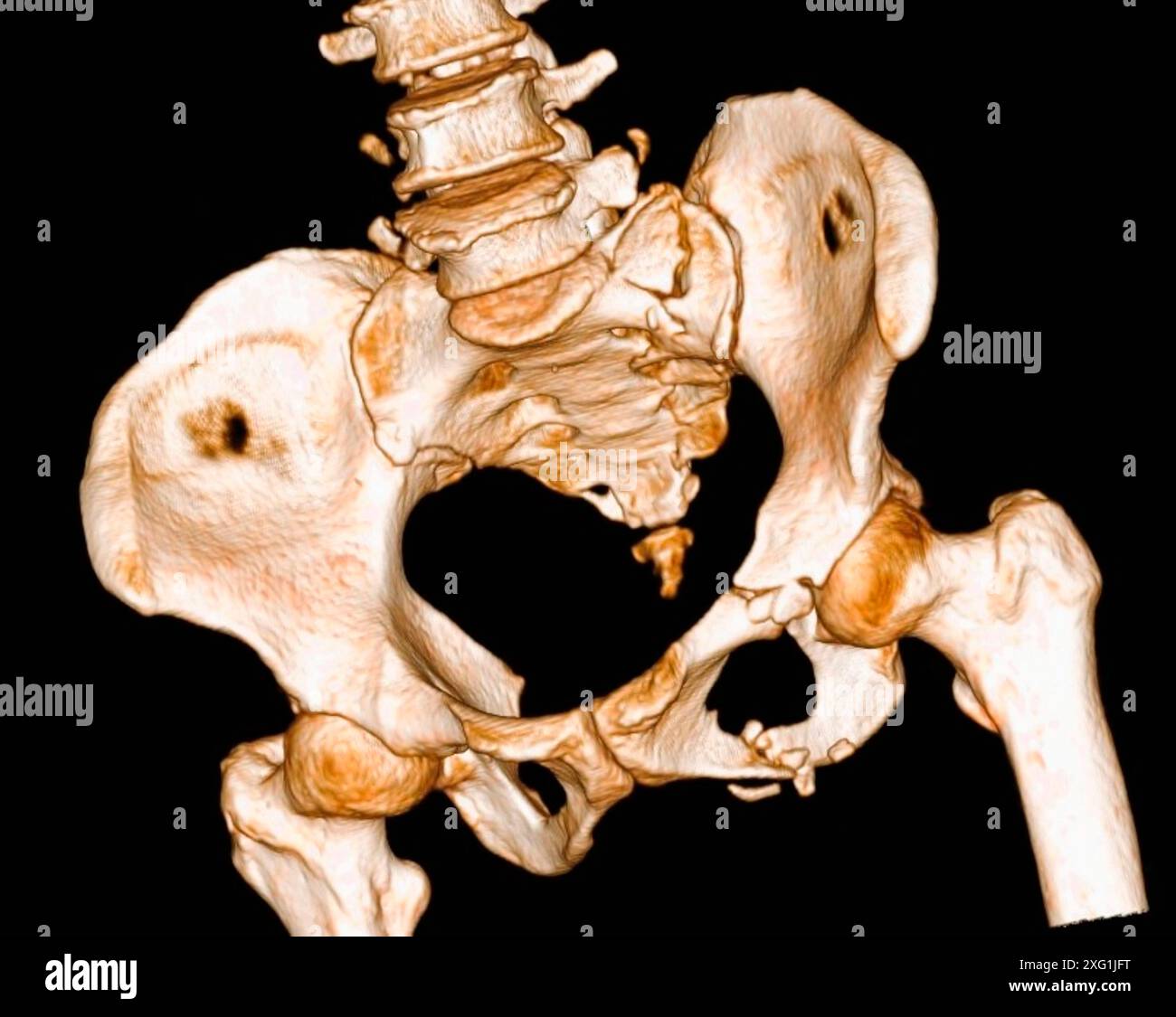 Ct of a pelvis hi-res stock photography and images - Alamy
