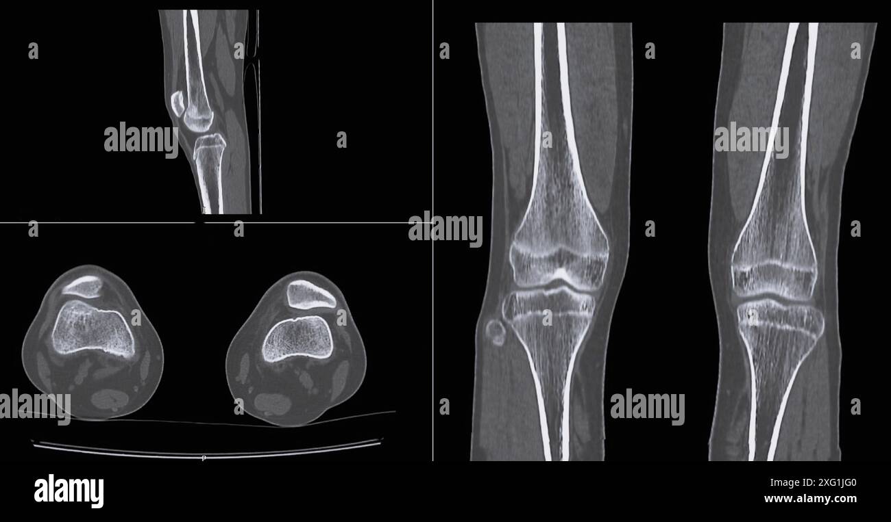 Computed tomography (CT) scan of healthy knees Stock Photo - Alamy