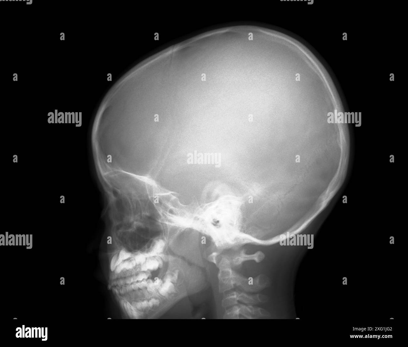 Nasal x ray Black and White Stock Photos & Images - Alamy