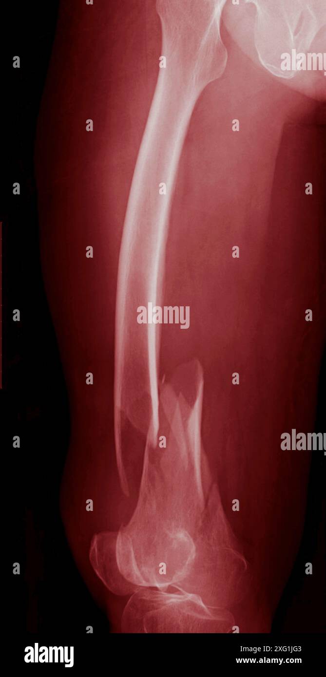 Coloured X Ray Of A Comminuted Femur Thigh Bone Fracture This Is A Type Of Fracture In Which