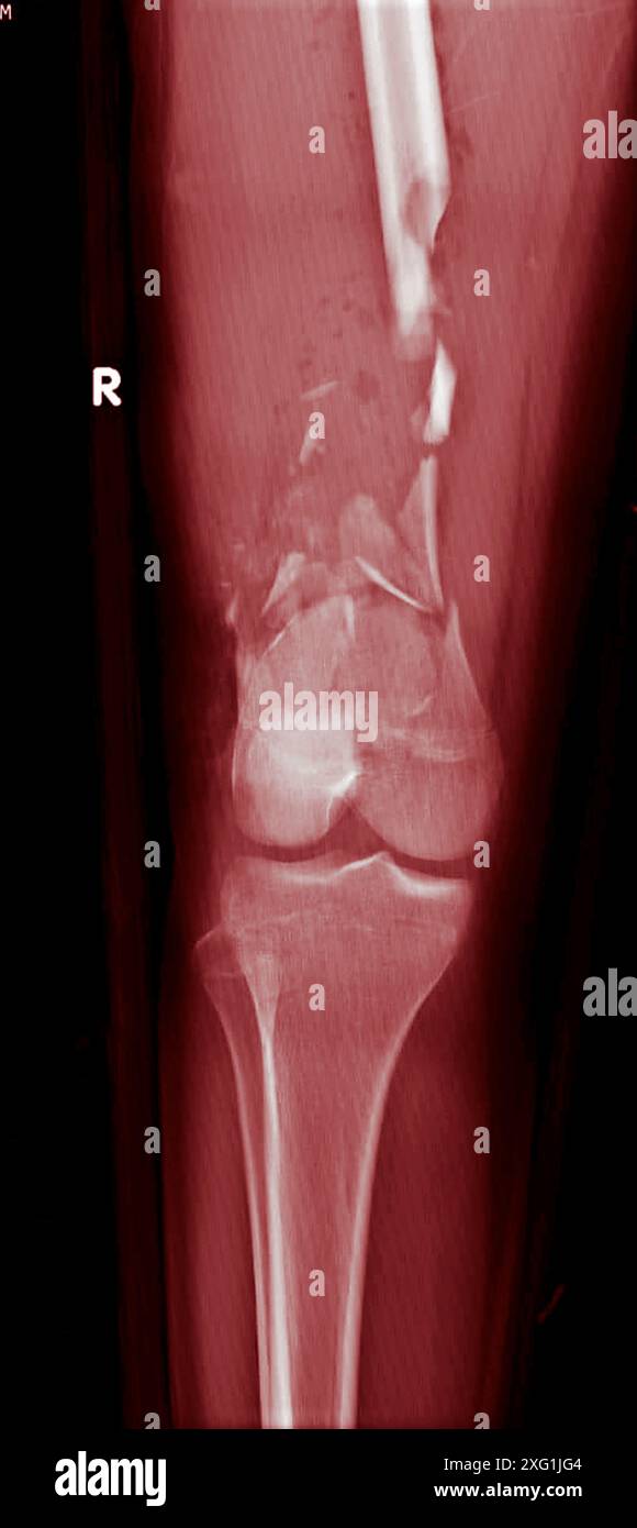 Coloured X-ray of a comminuted femur (thigh bone) fracture. This is a ...