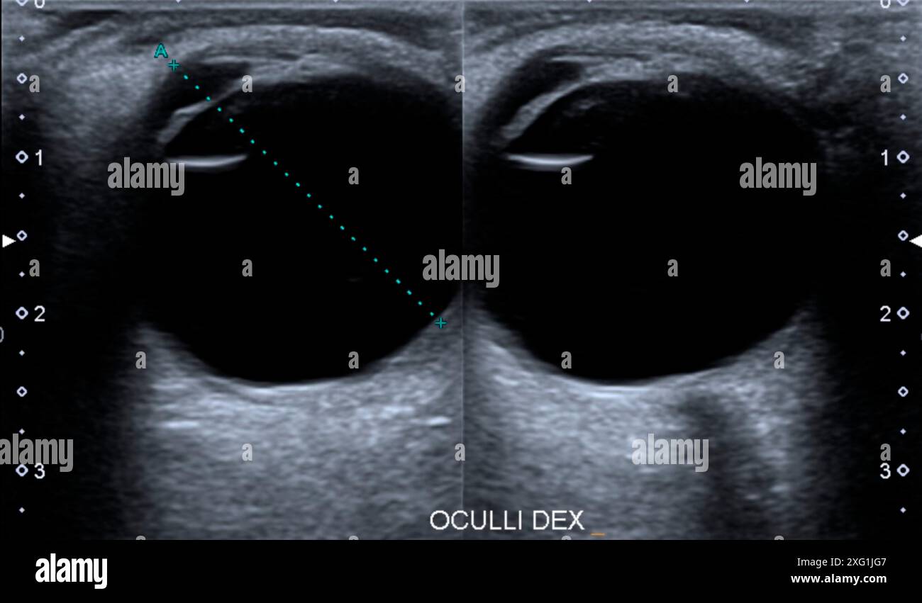 Ultrasound scan of a normal eye. Two views of the same eye are shown ...