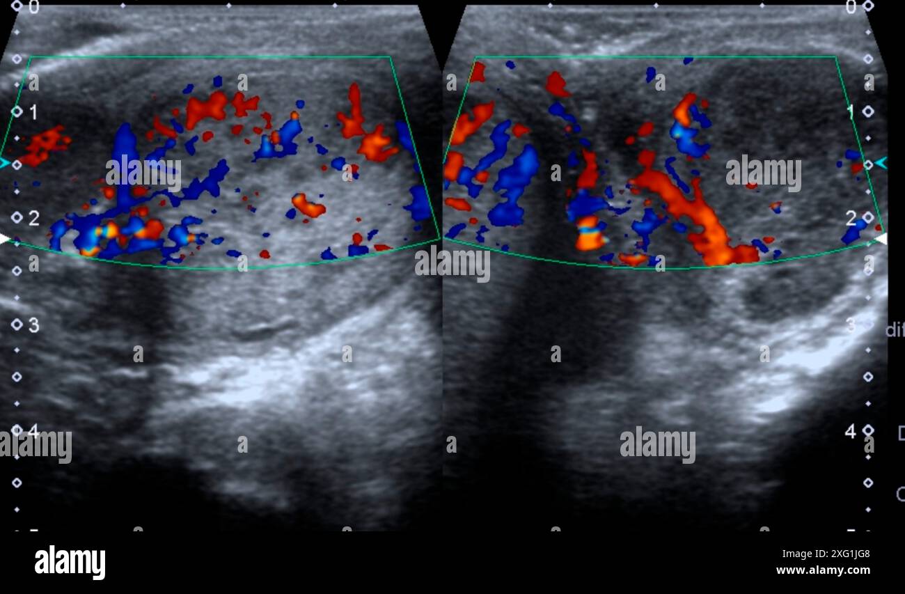 Ultrasound scan showing orchitis, an infection of the testicles. The ... Ultrasound scan showing orchitis, an infection of the testicles. The ...