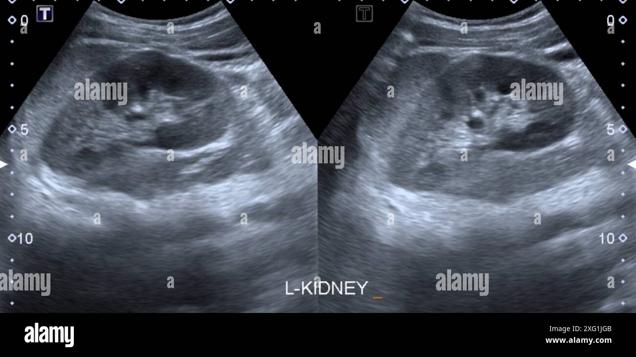 Ultrasound scan of a normal kidney Stock Photo - Alamy
