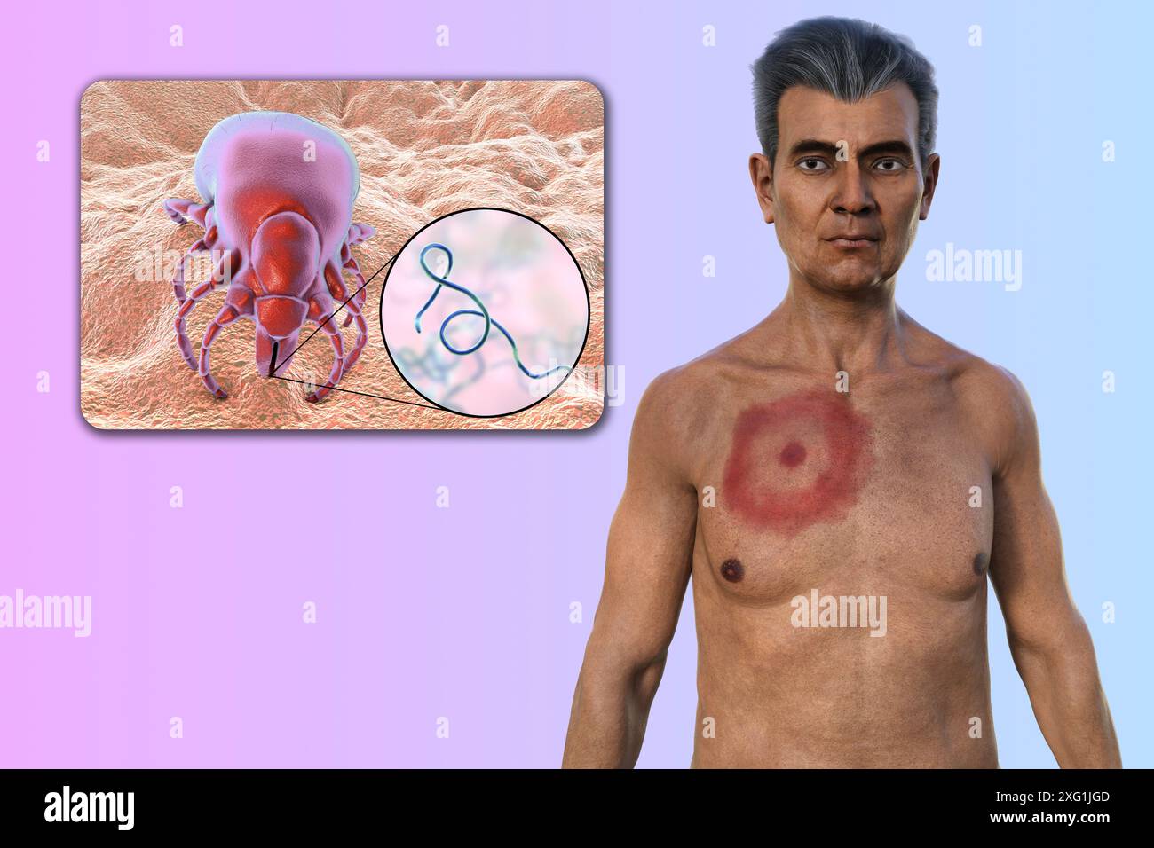 Illustration showing erythema migrans, a characteristic rash seen in ...