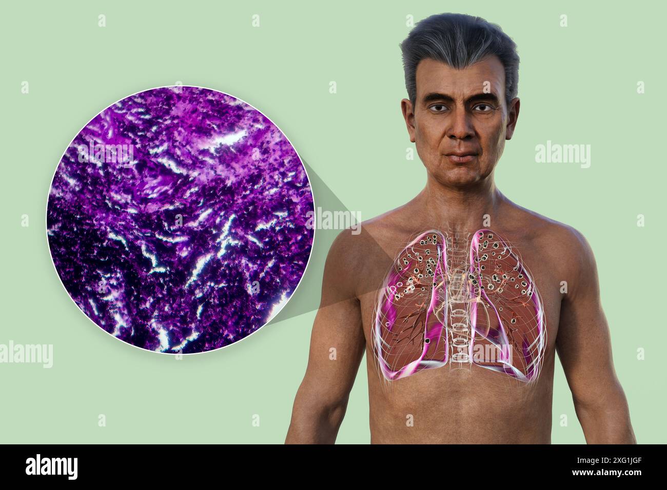 Illustration of a man with lungs affected by silicosis, showing dark ...