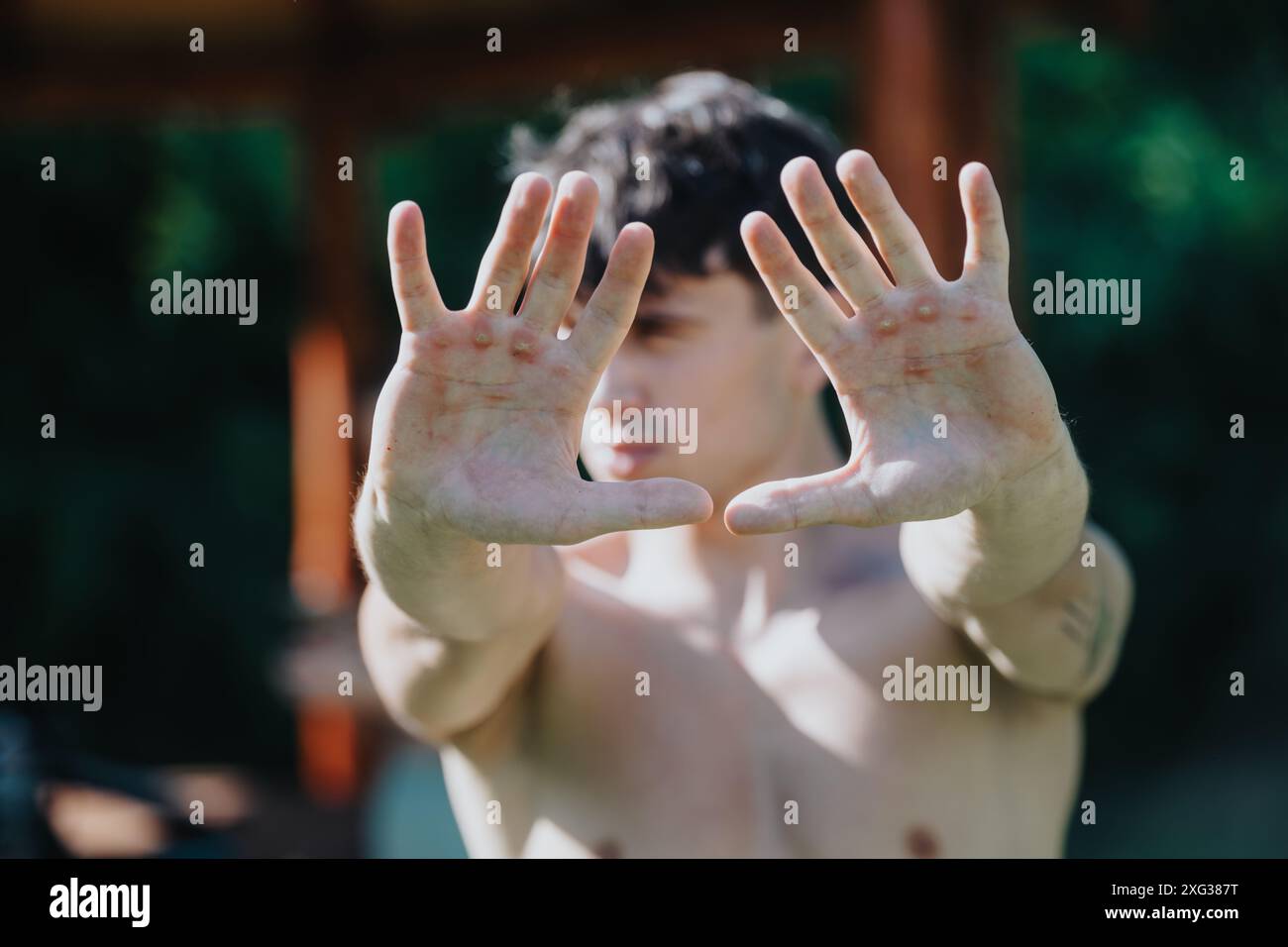 Young athletic man showing hands with calluses from intense sports ...