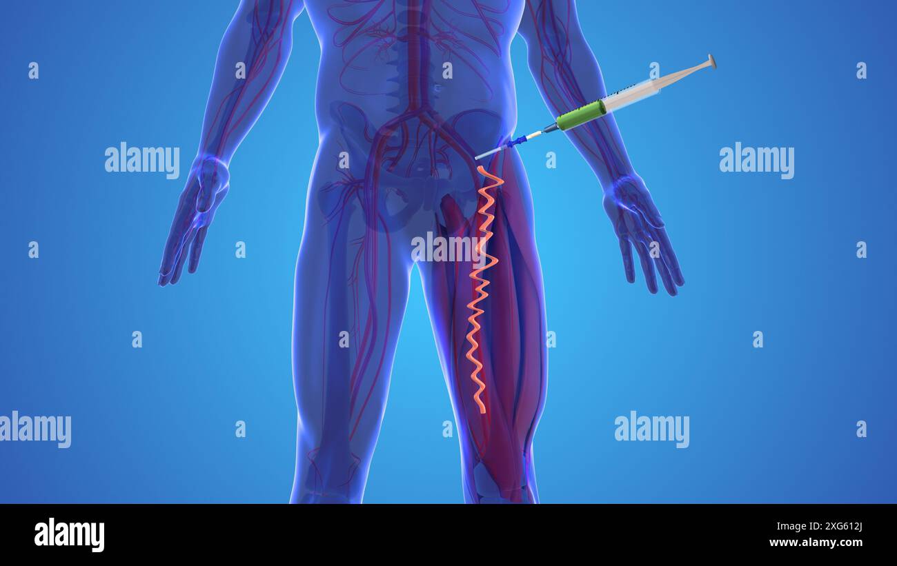 Sclerotherapy treatment for varicose and spider veins Stock Photo - Alamy