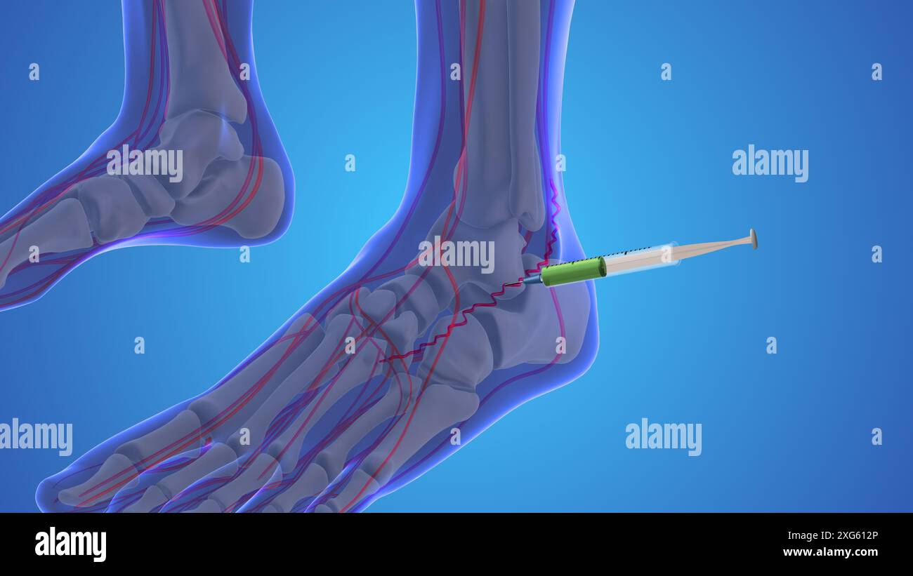 varicose veins treatment medical animation Stock Photo - Alamy