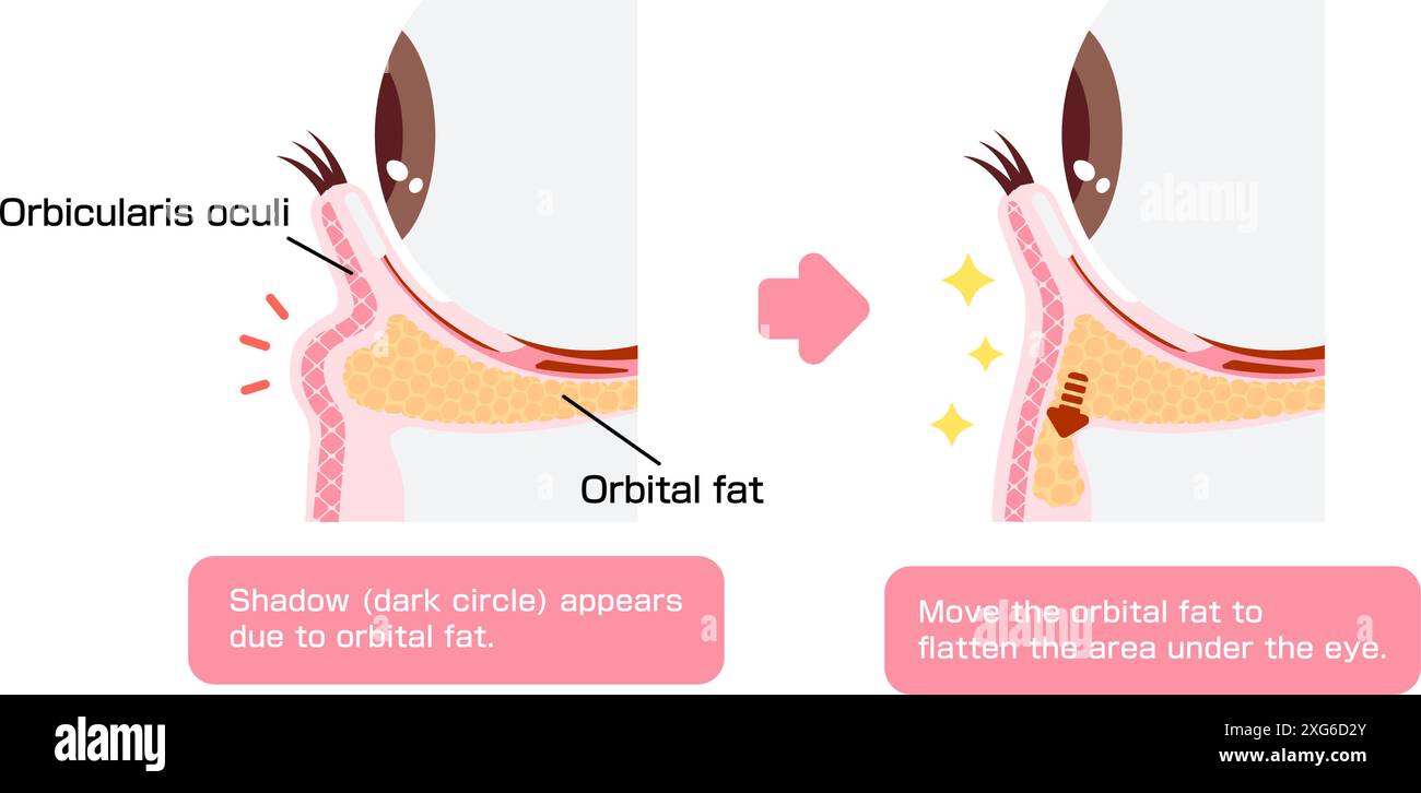 How to remove dark circles under the eyes with Lower blepharoplasty ...