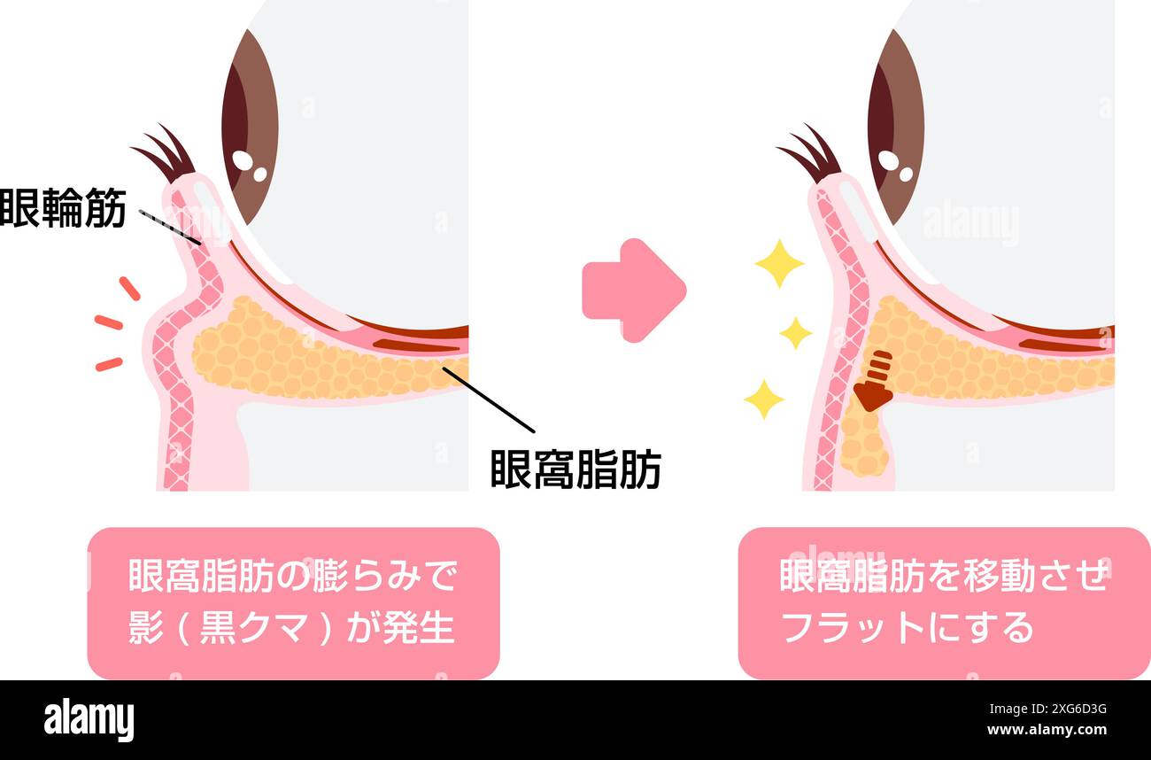How to remove dark circles under the eyes with Lower blepharoplasty ...