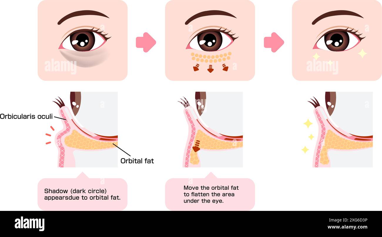 How to remove dark circles under the eyes with Lower blepharoplasty ...