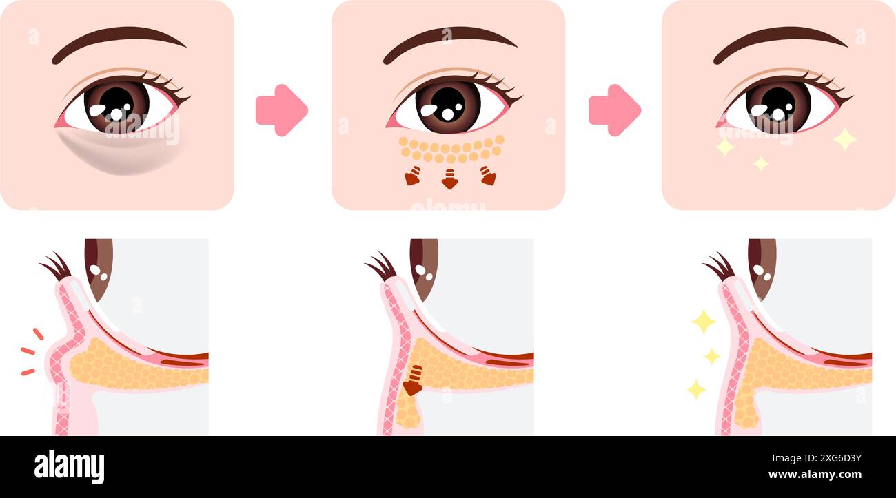 How to remove dark circles under the eyes with Lower blepharoplasty ...