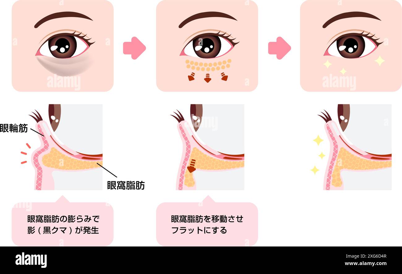 Dark circles woman before after eye Cut Out Stock Images & Pictures - Alamy