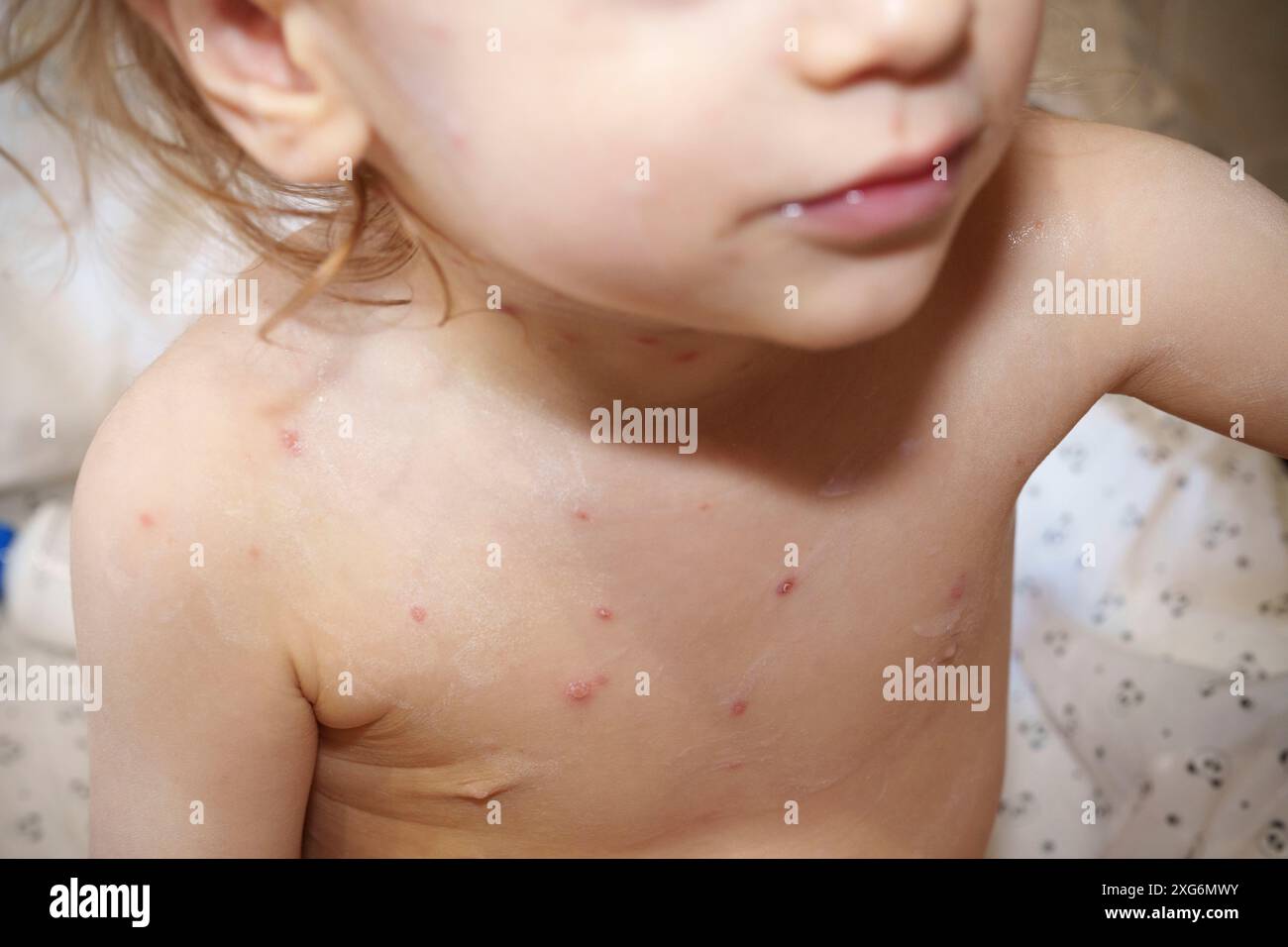 Young child with chicken pox (aka varicella) virus blisters Stock Photo ...