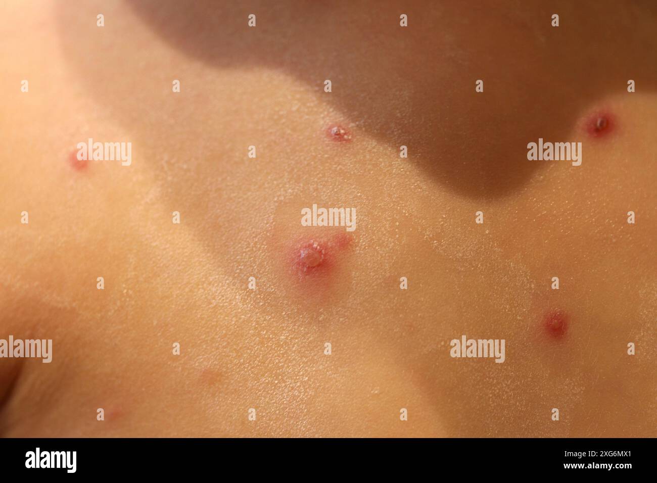 Young child with chicken pox (aka varicella) virus blisters Stock Photo ...