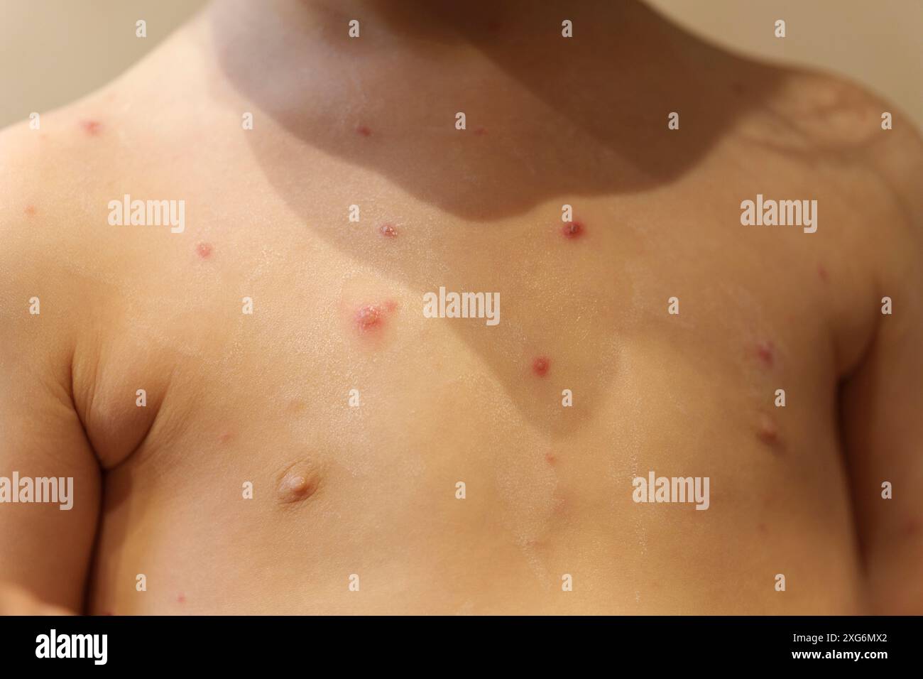 Young child with chicken pox (aka varicella) virus blisters Stock Photo ...
