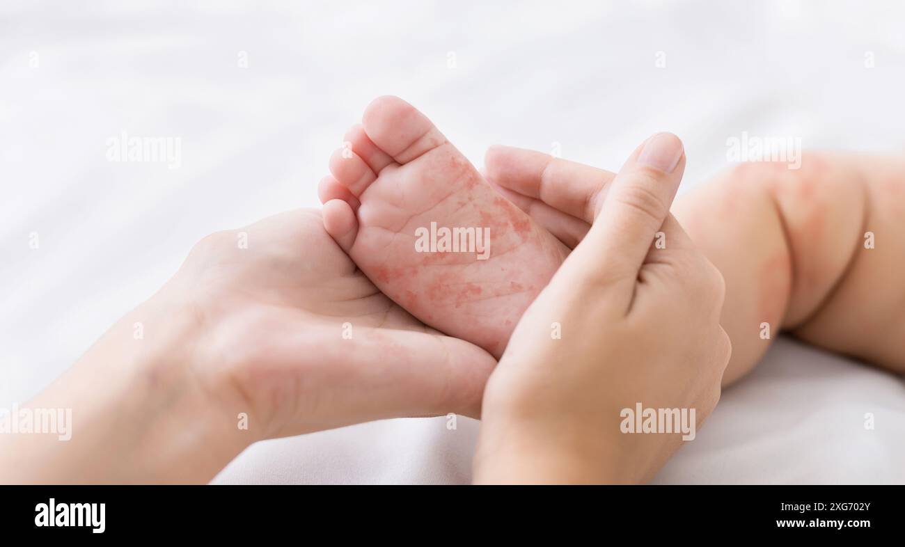 Mother holding tiny baby foot with measles rash Stock Photo - Alamy