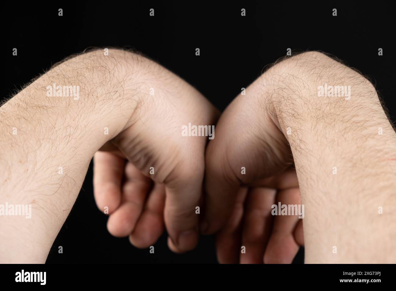 Comparison of healthy arm and arm with wrist ganglion cyst Stock Photo ...