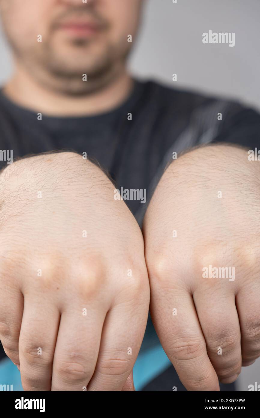 Comparison of healthy arm and arm with wrist ganglion cyst Stock Photo ...