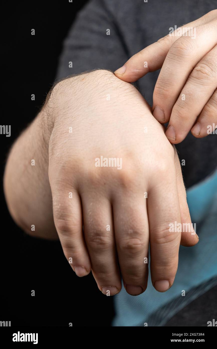 Ganglion cyst or hygroma of the wrist on the hand of a male patient ...