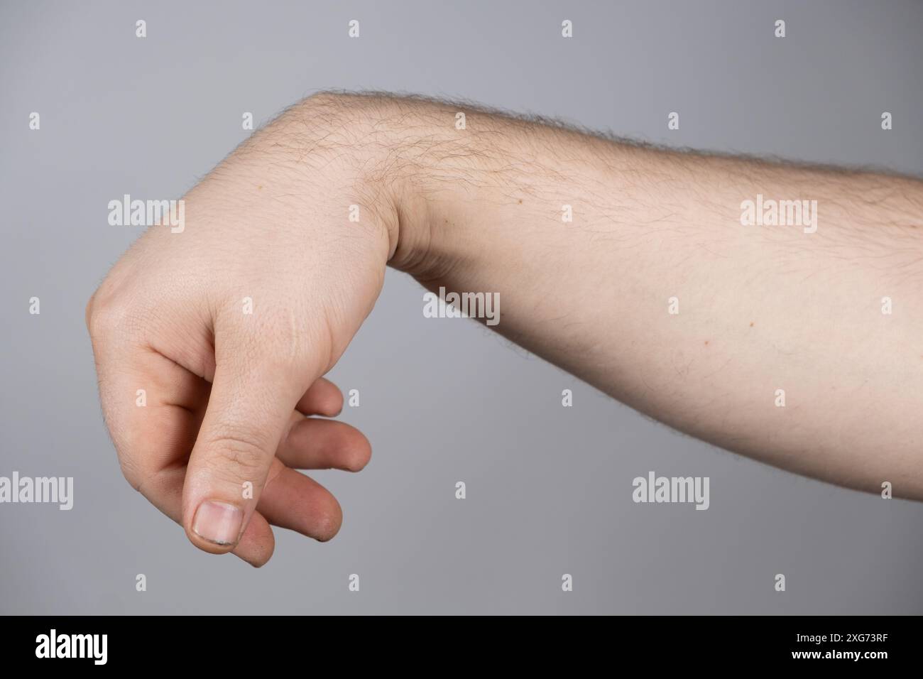 Ganglion cyst or hygroma of the wrist on the hand of a male patient ...