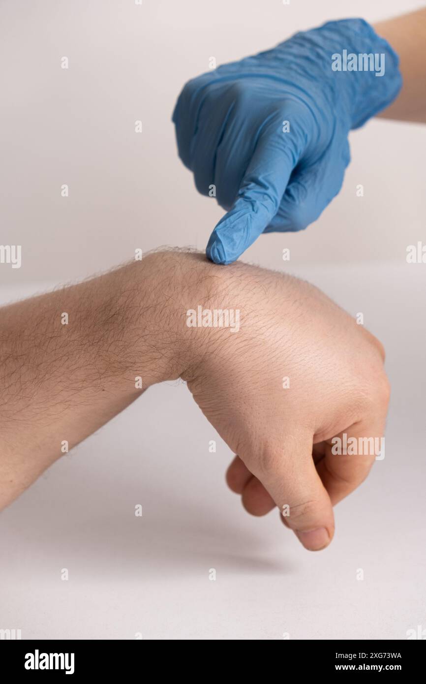 Ganglion cyst or hygroma of the wrist on the hand of a male patient ...