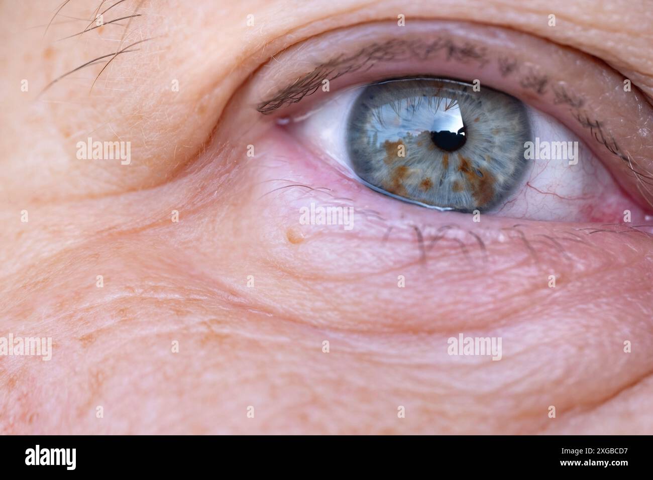 Puffy eyes of elderly Caucasian 55-year-old woman in close-up, swollen ...