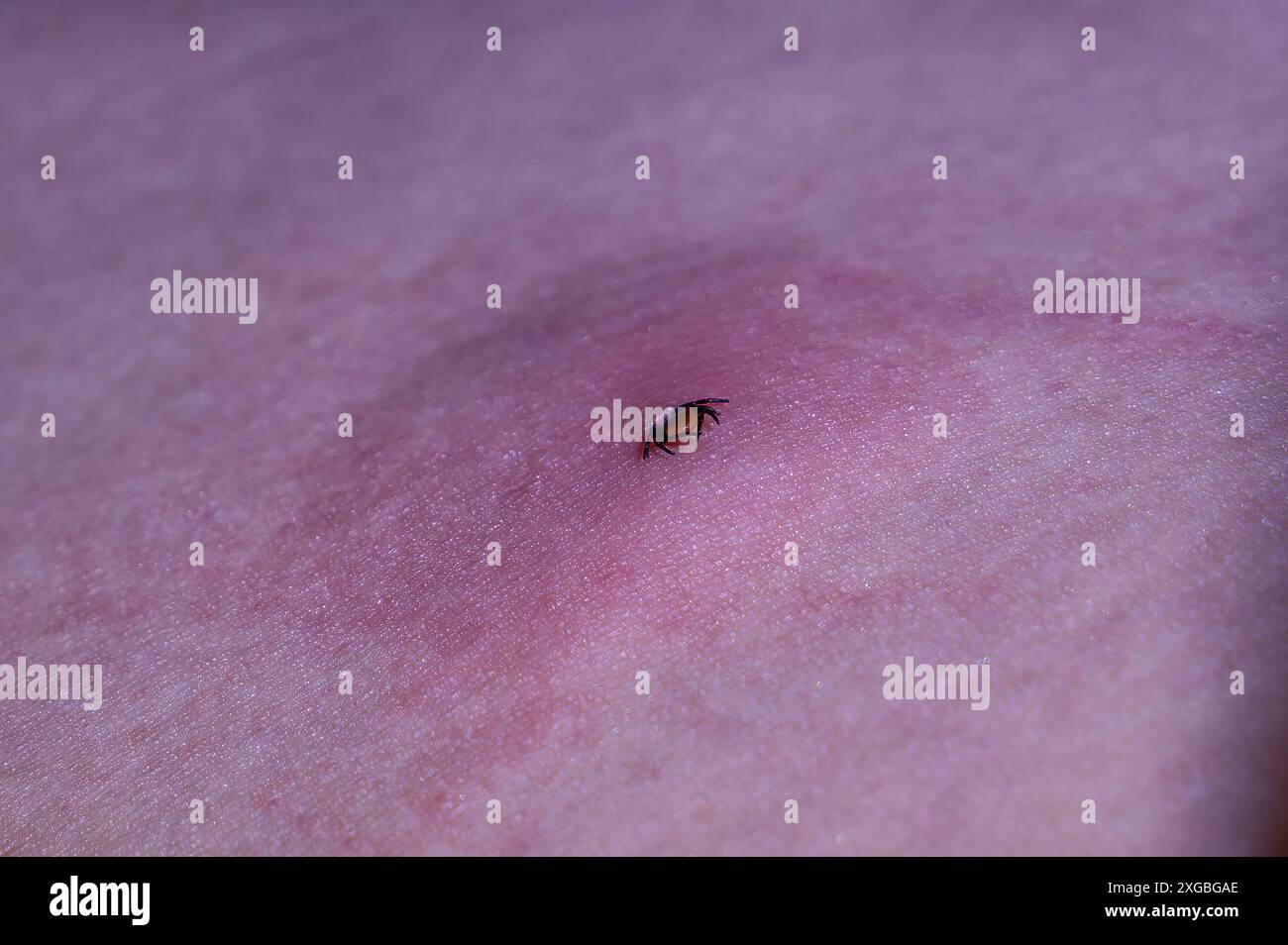 Blood-sucking ectoparasites - A tick full of blood on irritated human ...