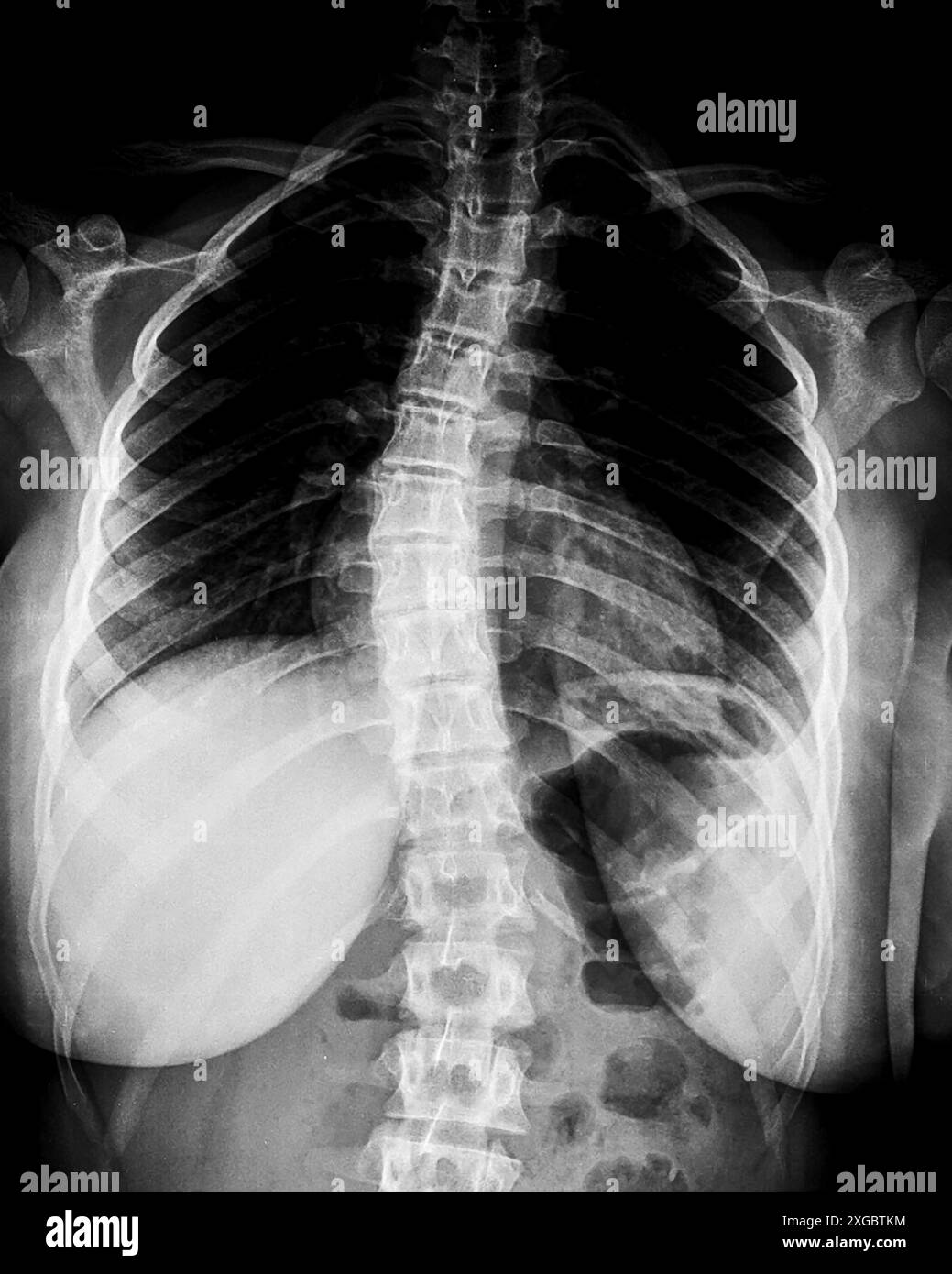 X-ray of idiopathic scoliosis of thoracic spine. Part of adolescent ...