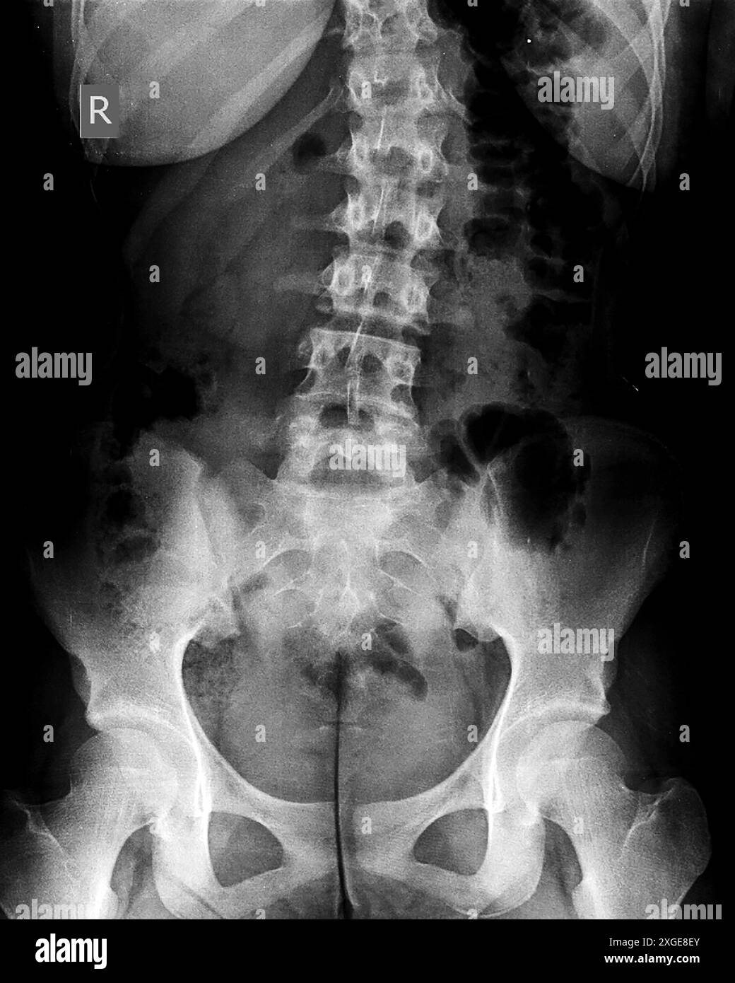 X-ray of idiopathic scoliosis of lumbar spine. Part of adolescent ...