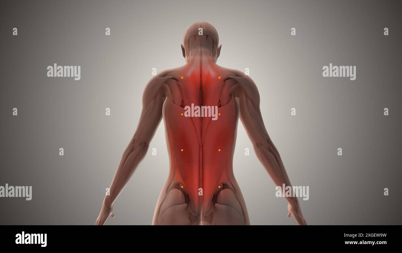 Myofascial pain syndrome or chronic pain disorder Stock Photo - Alamy