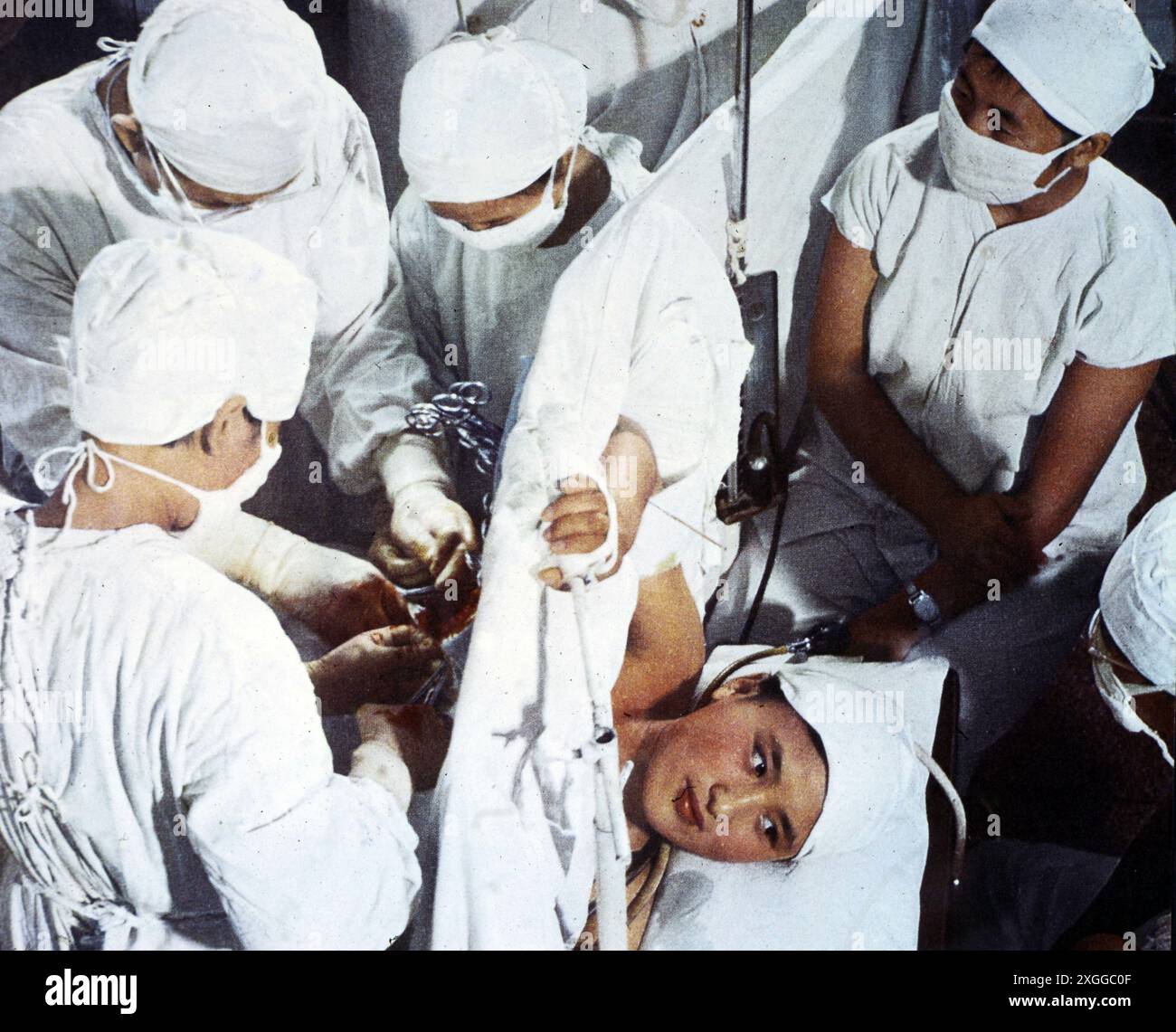 medicine, acupuncture, execution of surgery with acupuncture as anesthesia, China, 1973 ...