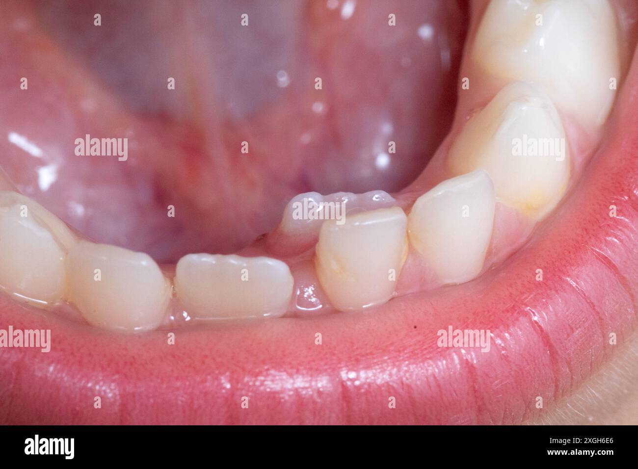 Close-up of lower gums and teeth showing dental issues and inflammation ...