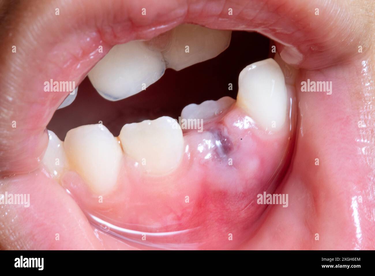 Mouth abscess hi-res stock photography and images - Alamy