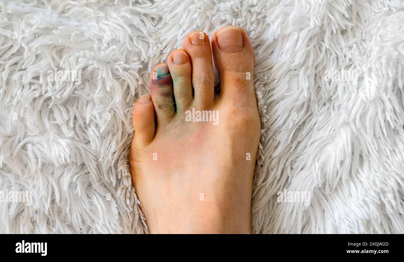 Bruise toe hi-res stock photography and images - Alamy