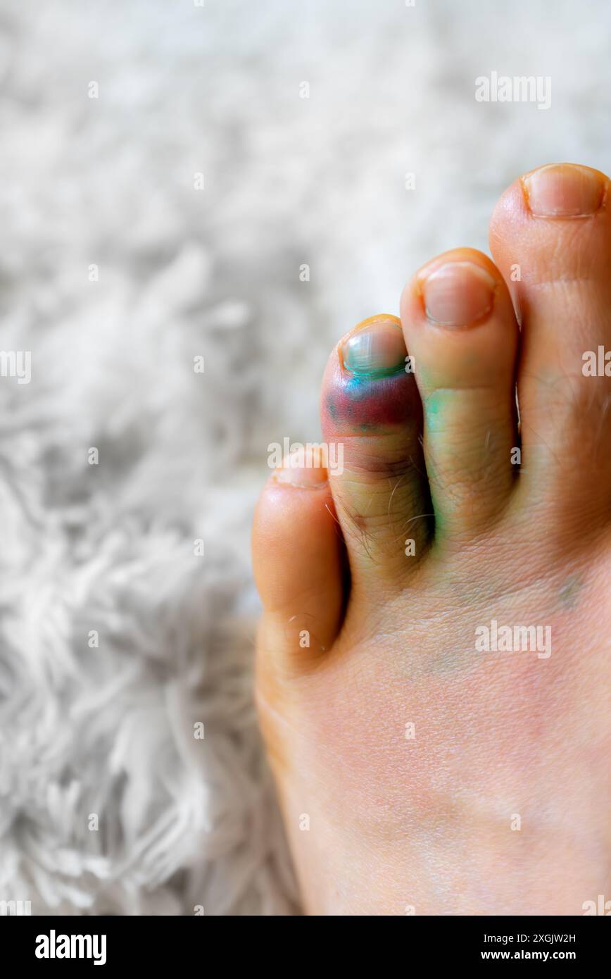 Bruise toe hi-res stock photography and images - Alamy