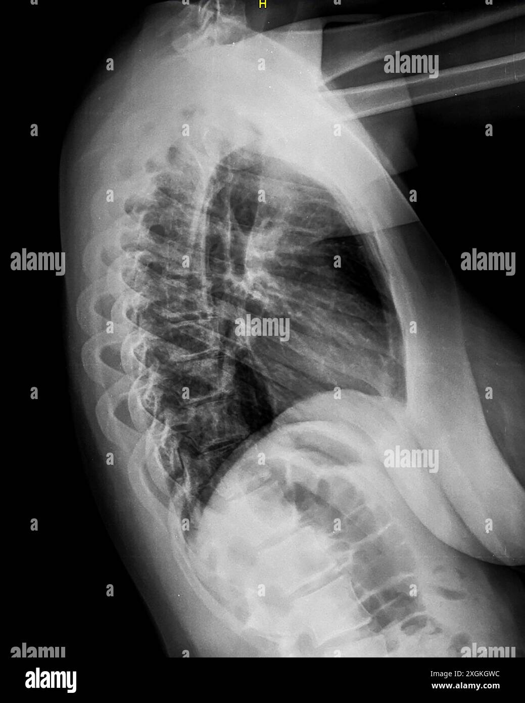 X Ray Of Thoracic Spine Lateral View Vertebrae And Intervertebral