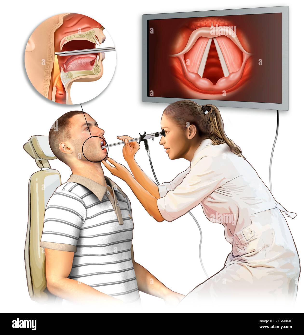 Illustration of a laryngoscopy procedure used to examine the larynx ...